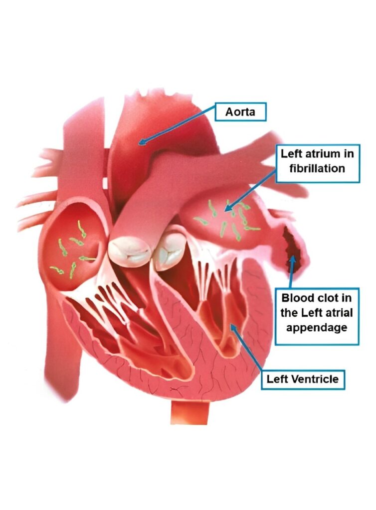 Left Atrial Appendage Closure | Pensinsula Cardiology Group