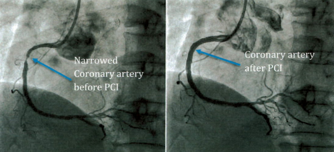 Percutaneous Coronary Intervention PCI Pensinsula Cardiology