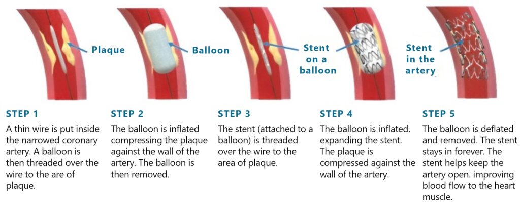 Percutaneous Coronary Intervention (PCI) | Pensinsula Cardiology