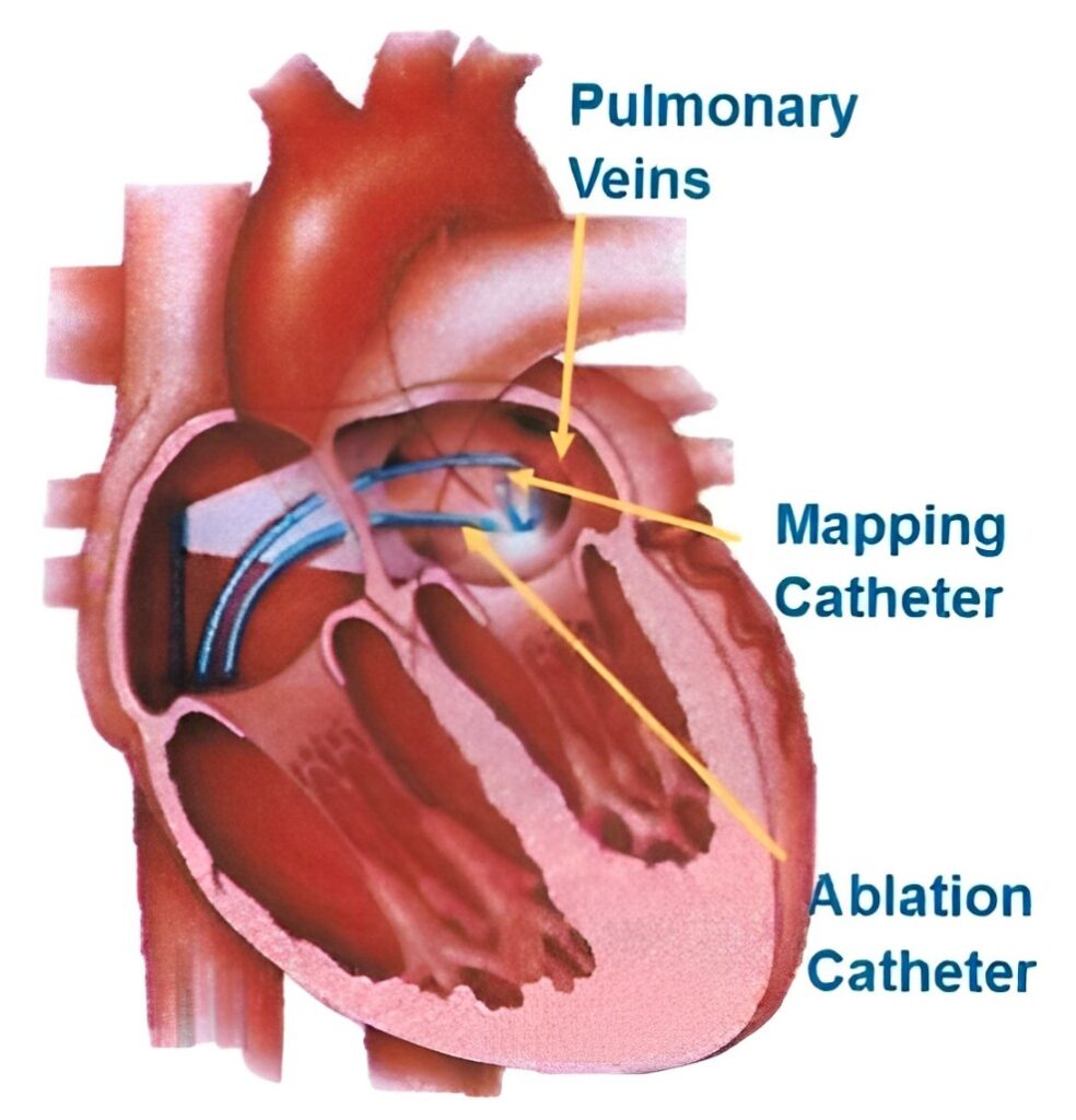Pulmonary Vein Isolation | Pensinsula Cardiology Group