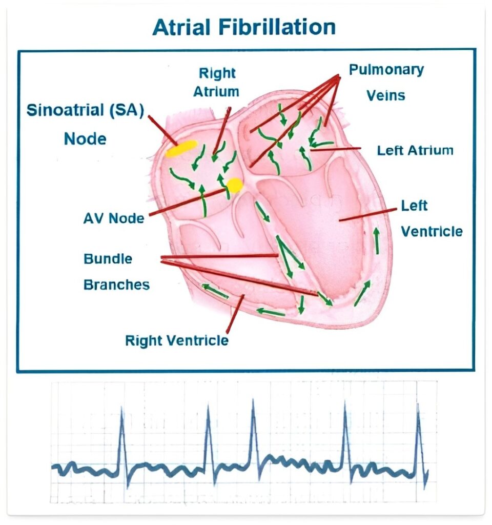 Pulmonary Vein Isolation | Pensinsula Cardiology Group