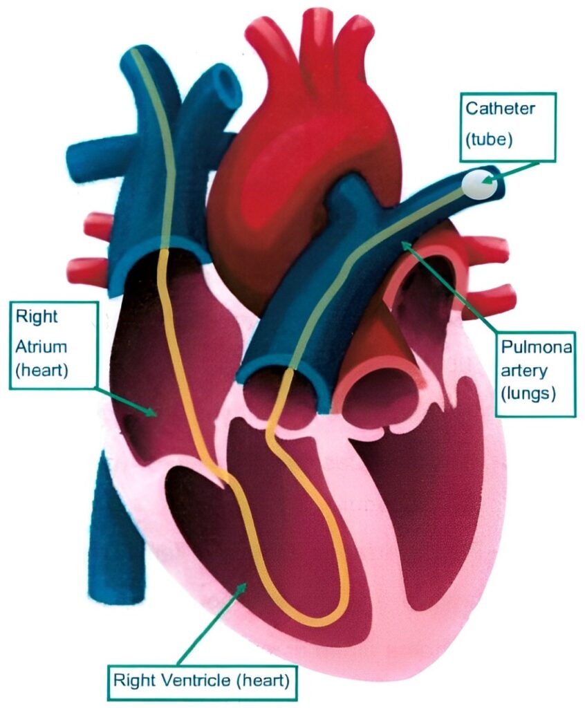 Right Heart Catheterisation | Pensinsula Cardiology Group