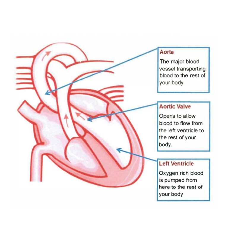 Transcatheter Aortic Valve Implantation (TAVI) | Pensinsula Cardiology