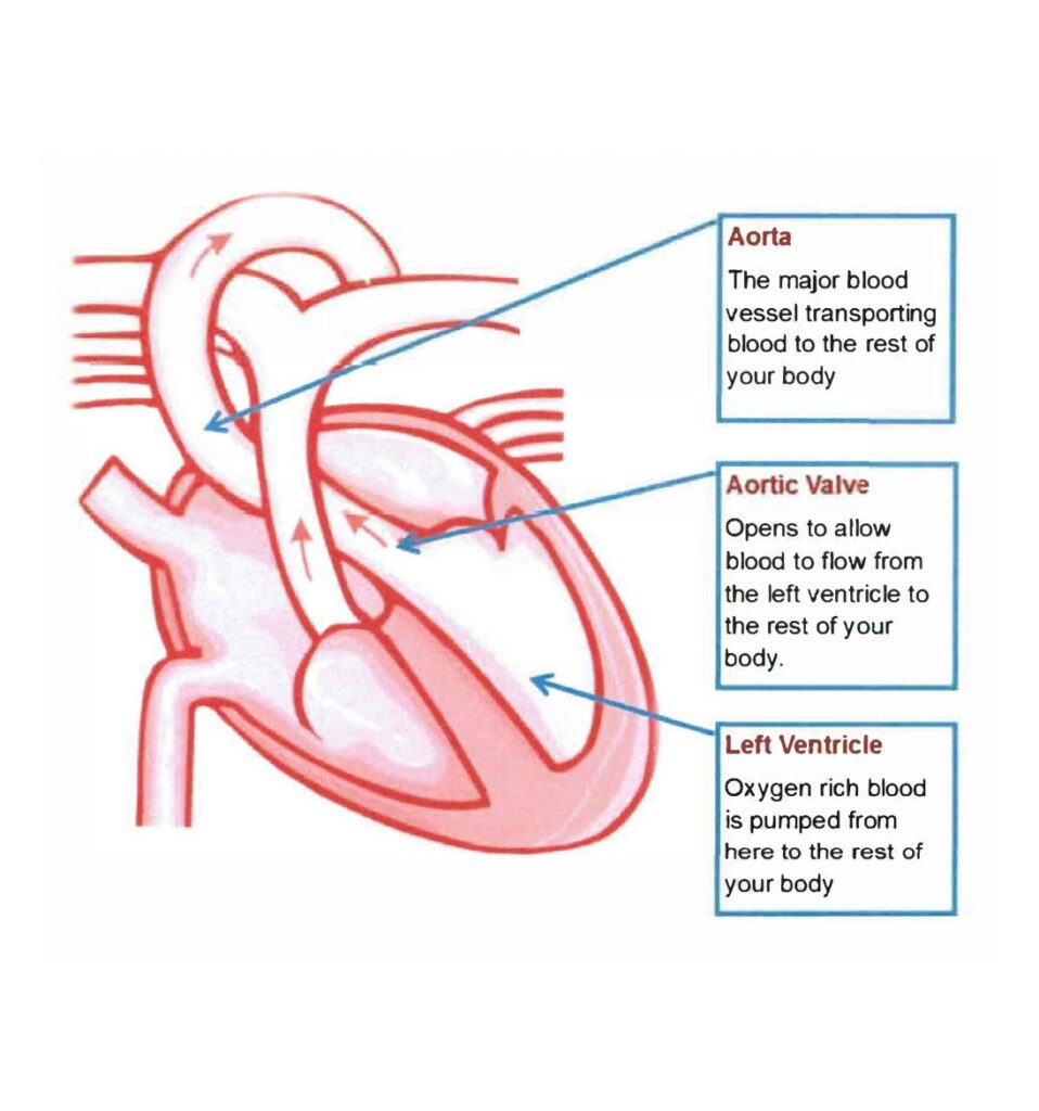 Transcatheter Aortic Valve Implantation (TAVI) | Pensinsula Cardiology