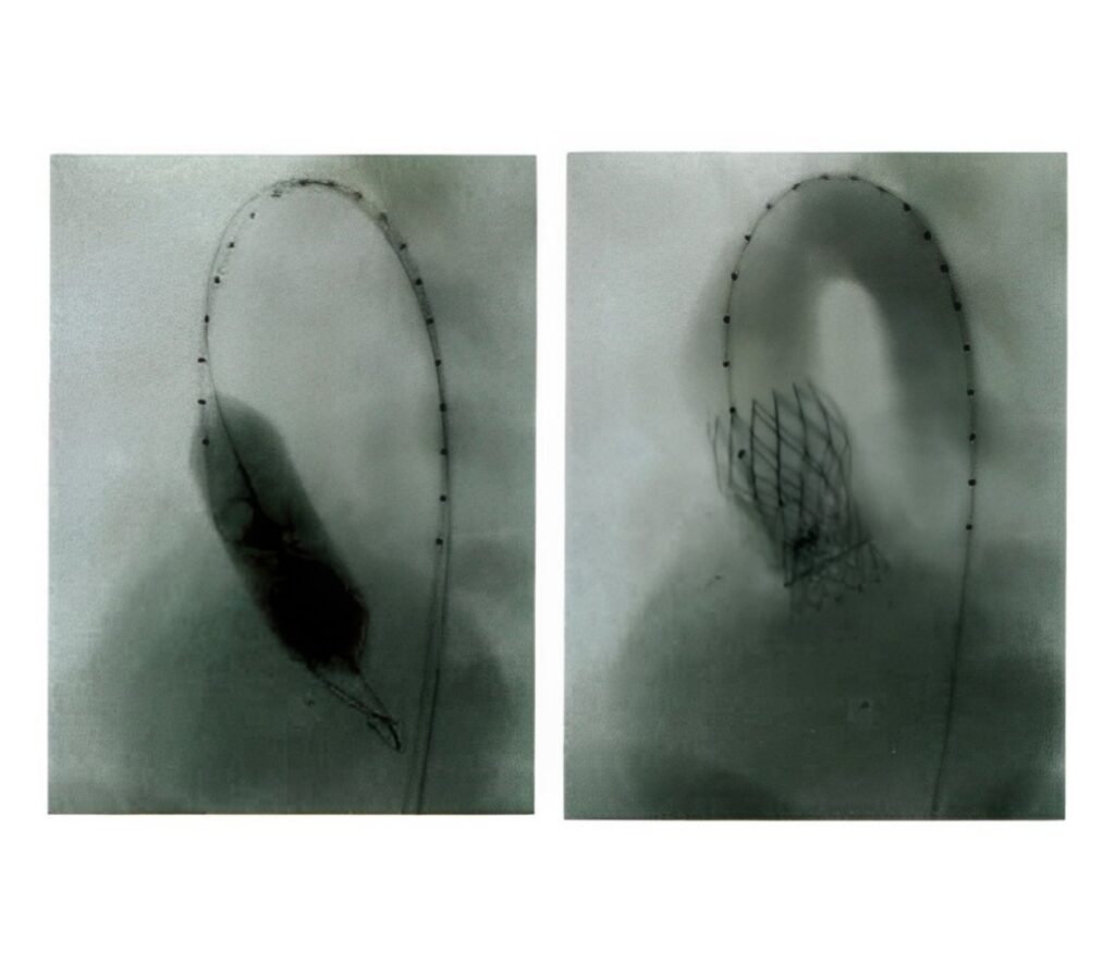 Transcatheter Aortic Valve Implantation (TAVI) | Pensinsula Cardiology