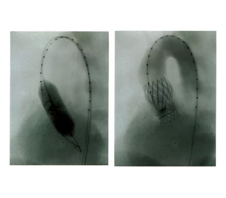 Transcatheter Aortic Valve Implantation (TAVI) | Pensinsula Cardiology