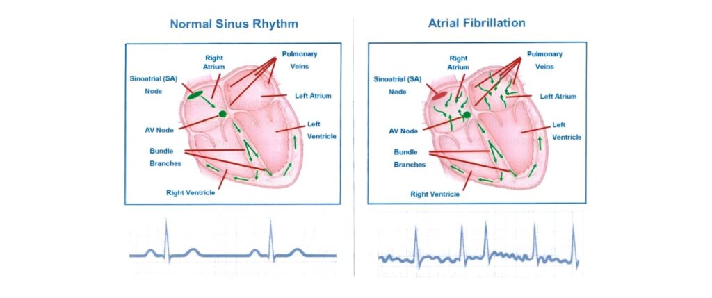 Transoesophageal Echocardiogram (TOE) | Pensinsula Cardiology