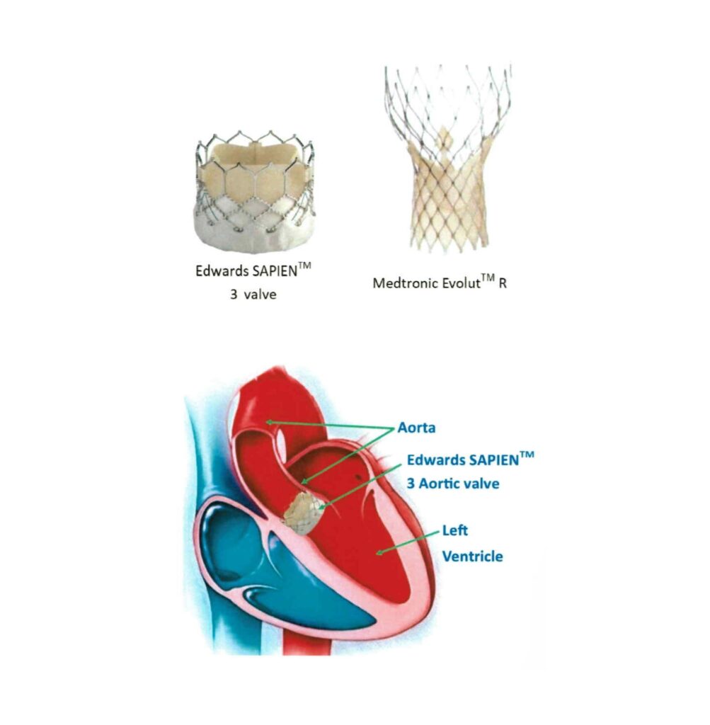 Transcatheter Aortic Valve Implantation (TAVI) | Pensinsula Cardiology