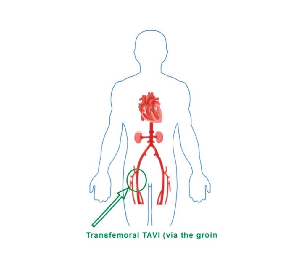 Transcatheter Aortic Valve Implantation (TAVI) | Pensinsula Cardiology