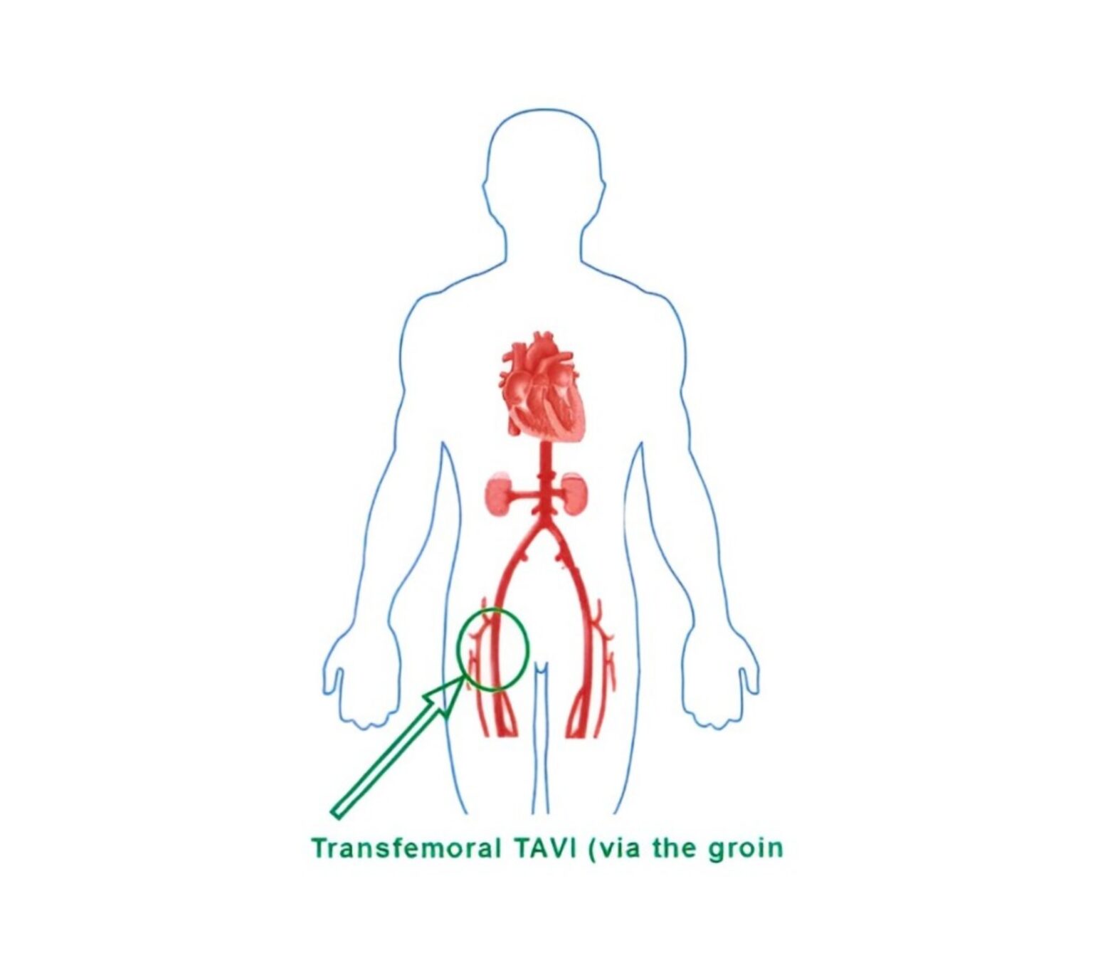 Transcatheter Aortic Valve Implantation (TAVI) | Pensinsula Cardiology